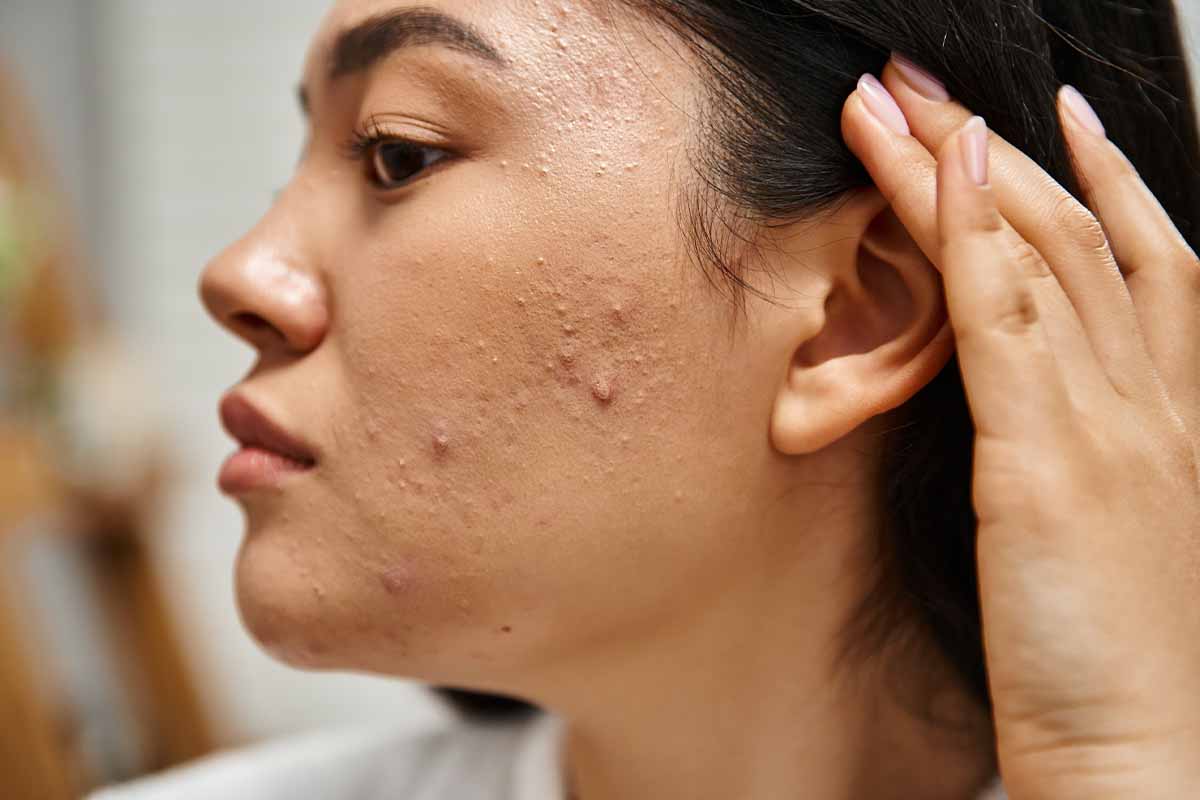 Cortisone Shots for Acne in Sacramento, CA | Aesthetic Envy